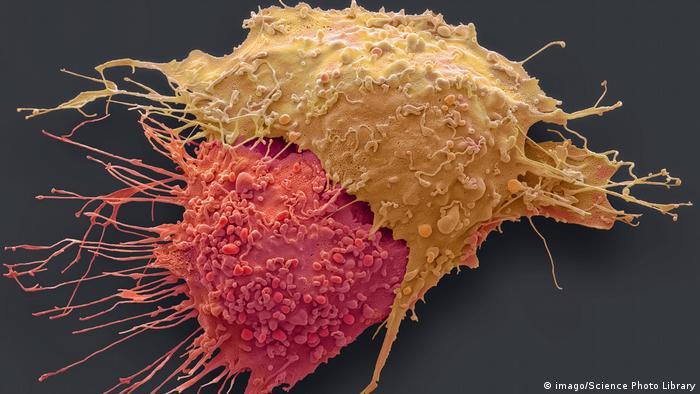 Ovarian cancer: New imaging drug makes cancer lesions visible